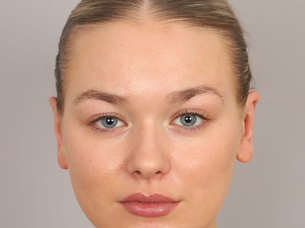 Ear Pinning(Pinnaplasty): What It Is, Cost, Before & After | UK | Bella Vou